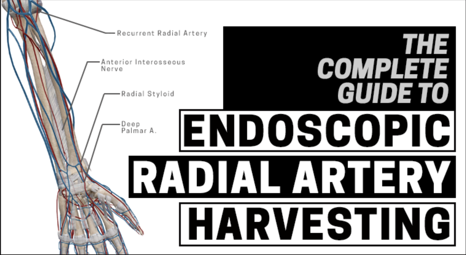 The Complete Guide to Endoscopic Radial Artery Harvesting - IAC